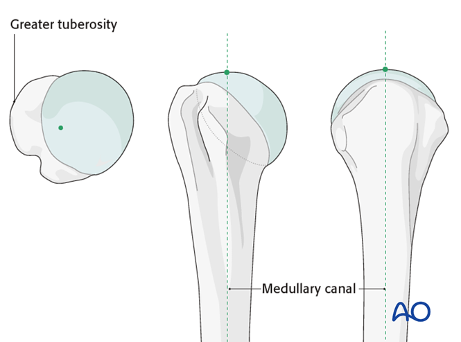 Nailing (straight nail) for Extraarticular 2-part, surgical neck, impaction