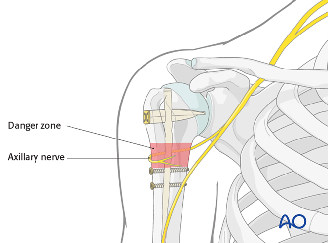 Nailing (bent nail) for Extraarticular 2-part, surgical neck, no impaction