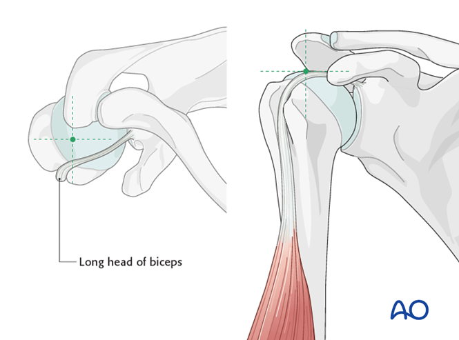 Nailing (straight nail) for Extraarticular 2-part, surgical neck, impaction