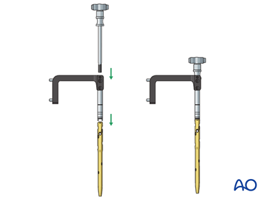 Nailing (straight nail) for Extraarticular 2-part, surgical neck, impaction