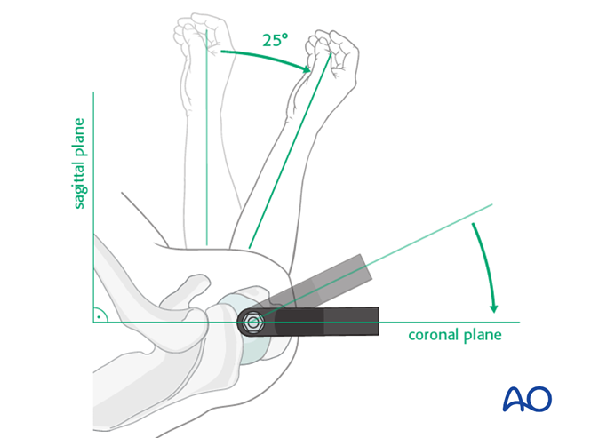 Nailing (straight nail) for Extraarticular 2-part, surgical neck, impaction