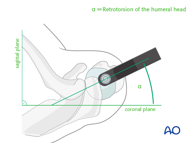 Nailing (straight nail) for Extraarticular 2-part, surgical neck, impaction
