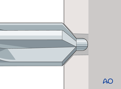 Nailing (straight nail) for Extraarticular 2-part, surgical neck, impaction