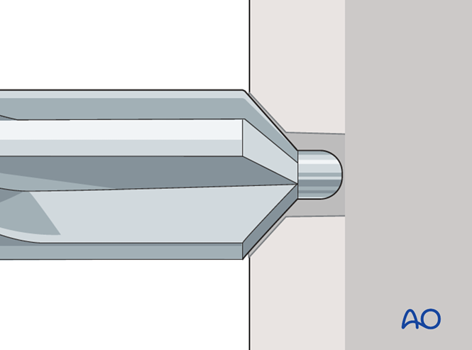Nailing (straight nail) for Extraarticular 2-part, surgical neck, impaction