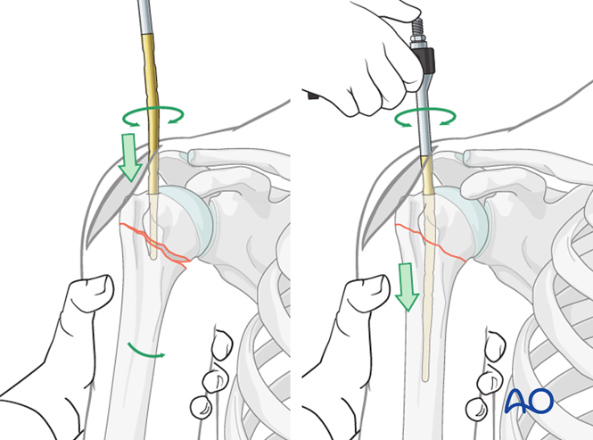 Nailing (bent nail) for Extraarticular 2-part, surgical neck, impaction