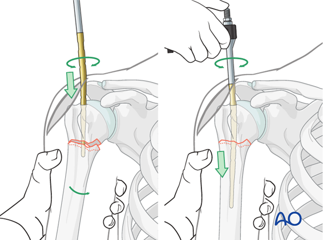 Nailing (bent nail) for Extraarticular 2-part, surgical neck, no impaction