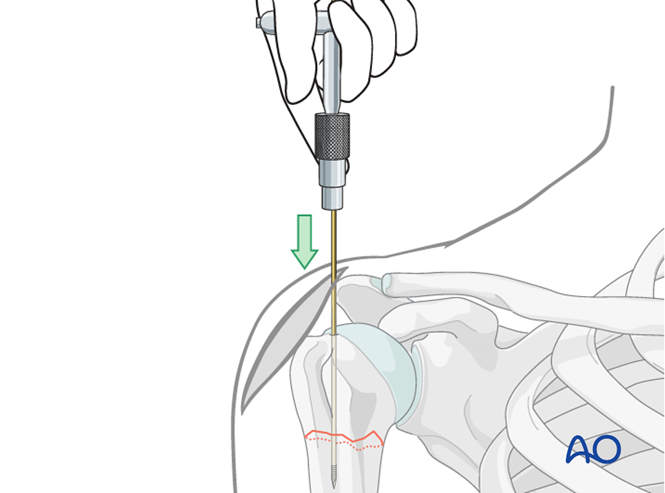 Nailing (bent nail) for Extraarticular 2-part, surgical neck, no impaction