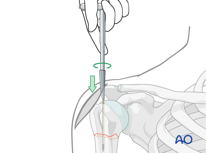 Nailing (bent nail) for Extraarticular 2-part, surgical neck, no impaction