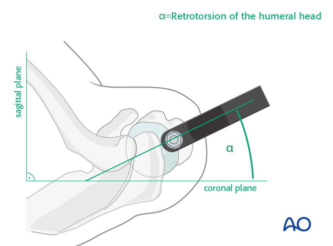 Nailing (bent nail) for Extraarticular 2-part, surgical neck, no impaction