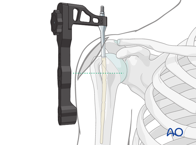 Nailing (bent nail) for Extraarticular 2-part, surgical neck, impaction