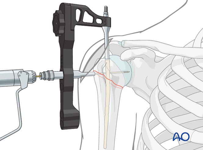 Nailing (bent nail) for Extraarticular 2-part, surgical neck, impaction