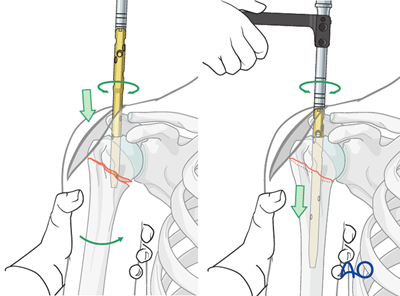 Nailing (straight nail) for Extraarticular 2-part, surgical neck, impaction