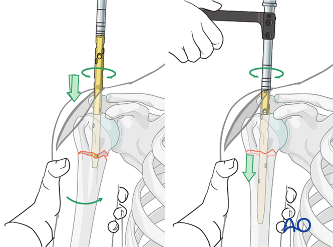 Nailing (straight nail) for Extraarticular 2-part, surgical neck, no ...