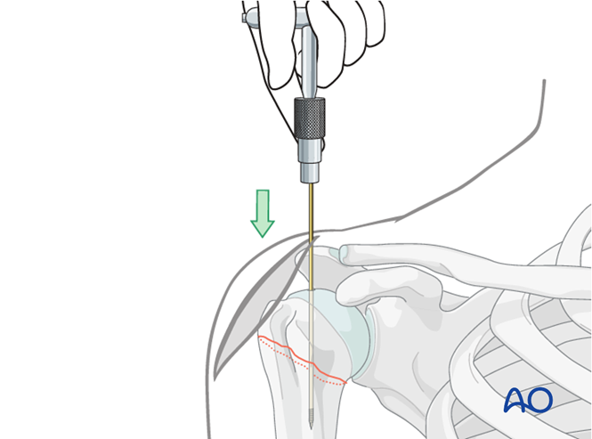 Nailing (straight nail) for Extraarticular 2-part, surgical neck, impaction