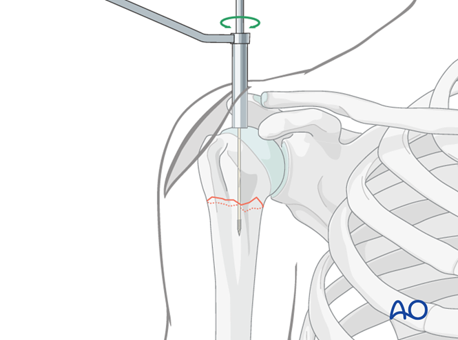 Nailing (straight nail) for Extraarticular 2-part, surgical neck, no ...