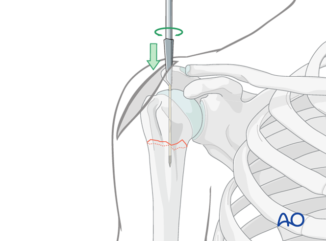 Nailing (straight nail) for Extraarticular 2-part, surgical neck, no ...