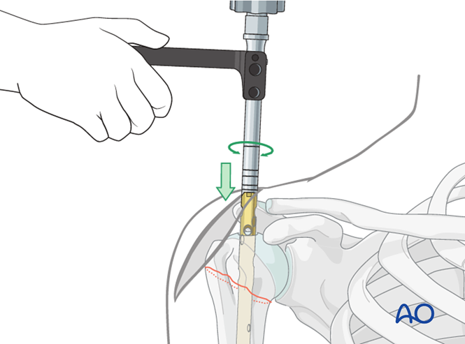 Nailing (straight nail) for Extraarticular 2-part, surgical neck, impaction