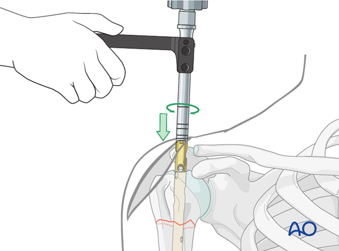 Nailing (straight nail) for Extraarticular 2-part, surgical neck, no ...