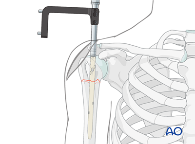 Nailing (straight nail) for Extraarticular 2-part, surgical neck, no ...