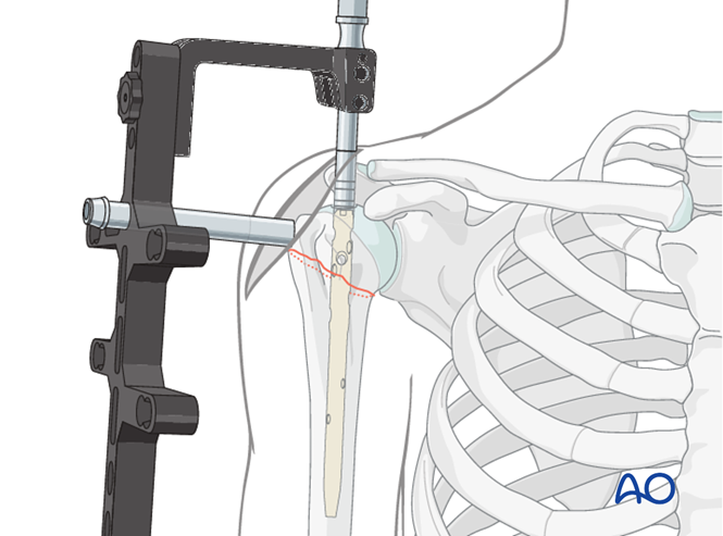 Nailing (straight nail) for Extraarticular 2-part, surgical neck, impaction