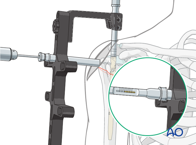 Nailing (straight nail) for Extraarticular 2-part, surgical neck, impaction