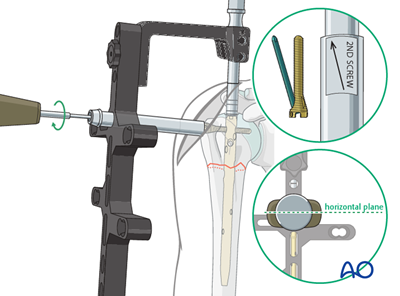 Nailing (straight nail) for Extraarticular 2-part, surgical neck, no ...