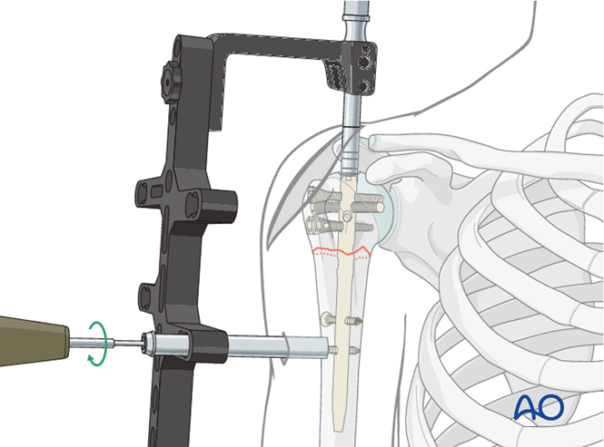 Nailing (straight nail) for Extraarticular 2-part, surgical neck, no ...