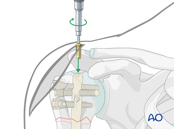 Nailing (straight nail) for Extraarticular 2-part, surgical neck, no ...