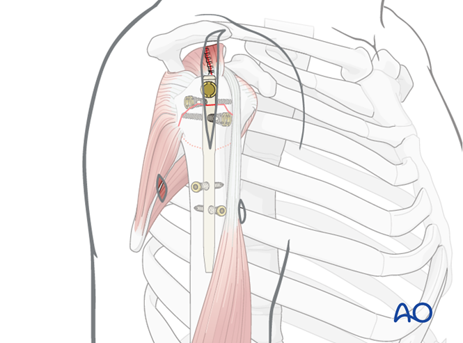 Nailing (straight nail) for Extraarticular 2-part, surgical neck, impaction