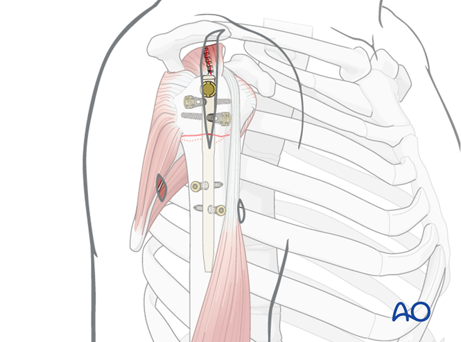 Nailing (straight nail) for Extraarticular 2-part, surgical neck, no ...