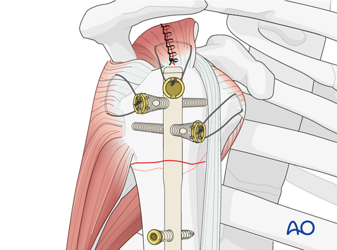 Nailing (straight nail) for Extraarticular 2-part, surgical neck, no ...