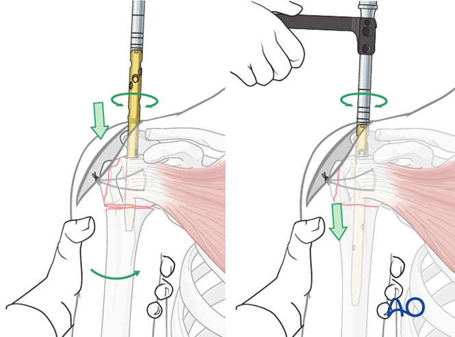 Nailing for Extraarticular 3-part, surgical neck and greater tuberosity ...