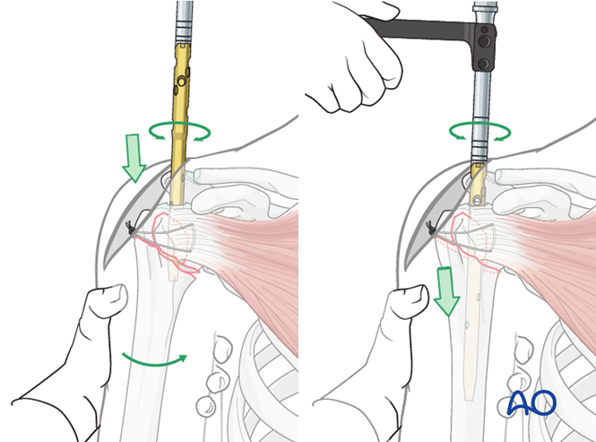 Nailing for Extraarticular 3-part, surgical neck and lesser tuberosity ...