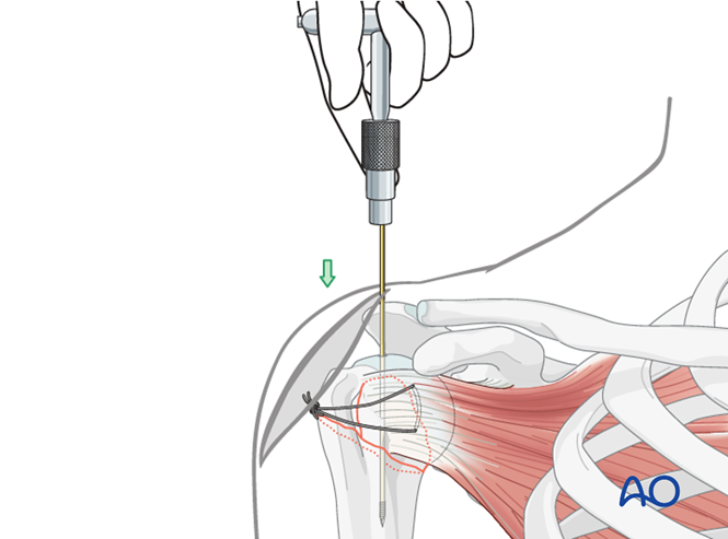 Nailing for Extraarticular 3-part, surgical neck and lesser tuberosity ...
