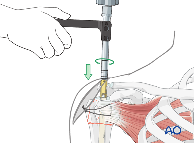 Nailing for Extraarticular 3-part, surgical neck and greater tuberosity ...