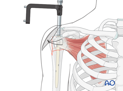 Nailing for Extraarticular 3-part, surgical neck and tuberosity, no ...
