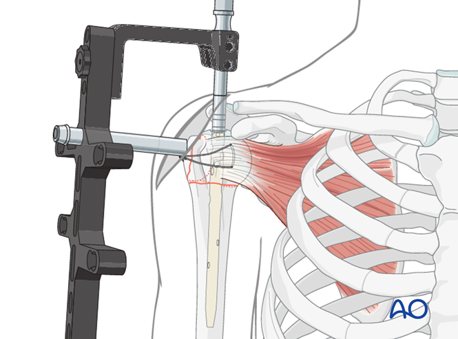 Nailing for Extraarticular 3-part, surgical neck and greater tuberosity ...