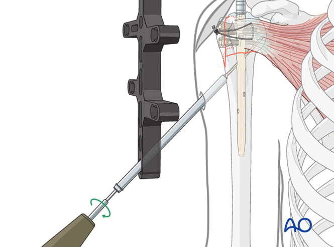 Nailing for Extraarticular 3-part, surgical neck and tuberosity, no ...