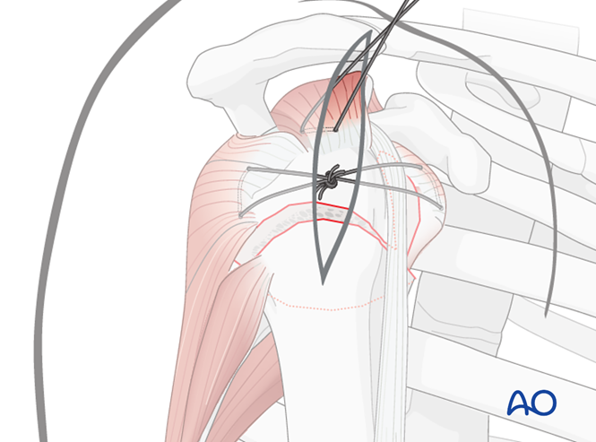 Nailing for Extraarticular 3-part, surgical neck and lesser tuberosity ...
