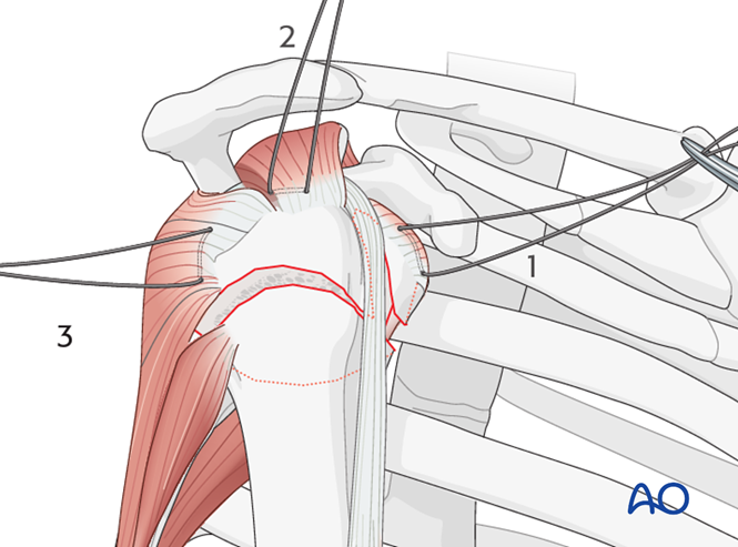 Nailing for Extraarticular 3-part, surgical neck and lesser tuberosity ...