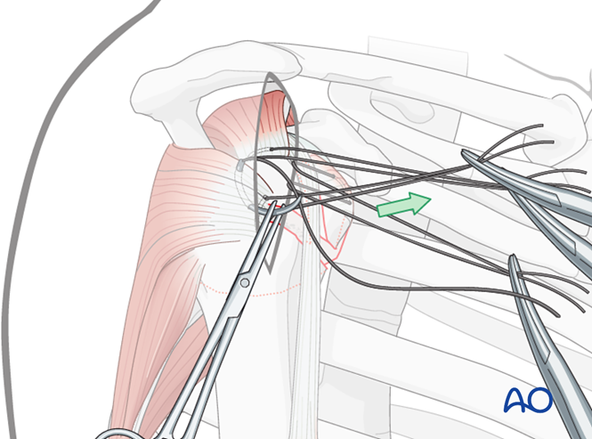 Nailing for Extraarticular 3-part, surgical neck and lesser tuberosity ...