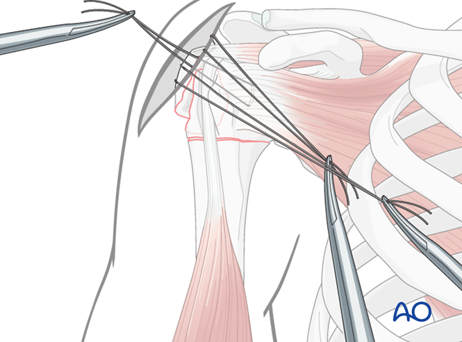 Nailing for Extraarticular 3-part, surgical neck and greater tuberosity ...