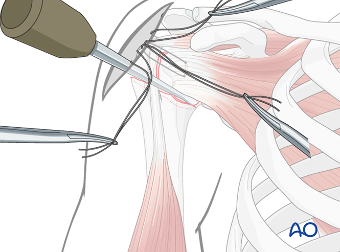 Nailing for Extraarticular 3-part, surgical neck and lesser tuberosity ...