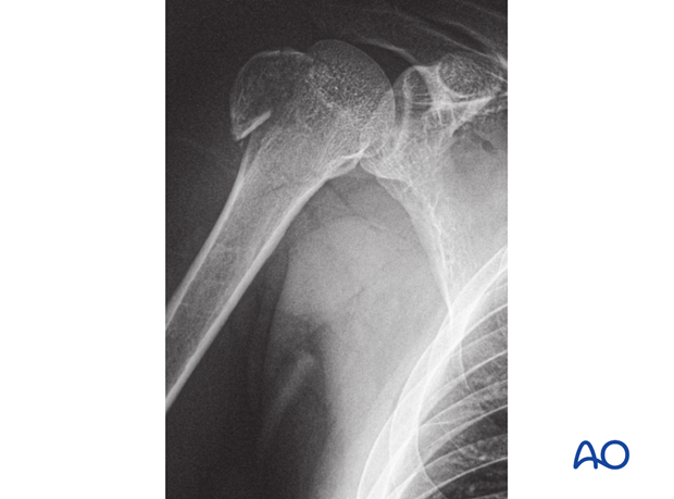 Extraarticular 2 Part Greater Tuberosity Displaced