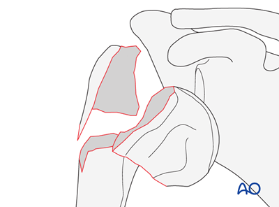 Extraarticular 3-part, surgical neck and tuberosity, dislocation