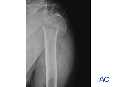 Extraarticular 3-part, surgical neck and tuberosity, dislocation