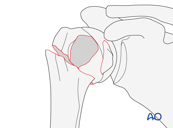 Extraarticular 3-part, surgical neck and tuberosity, dislocation