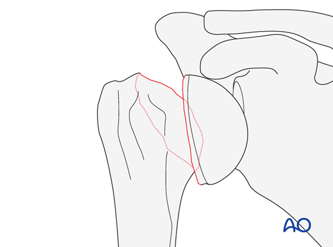 Isolated anatomical neck, dislocation
