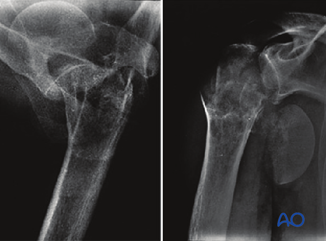 4-Part, dislocation, simple metaphyseal, intact articular