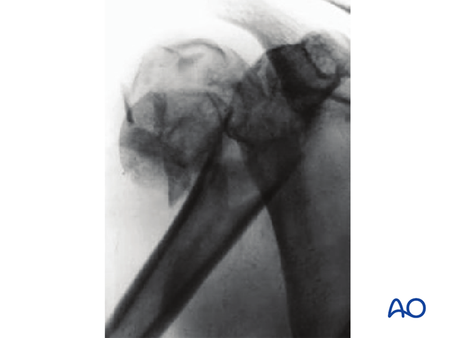 4-Part, dislocation, fragmentary metaphyseal +/- fragmentary articular